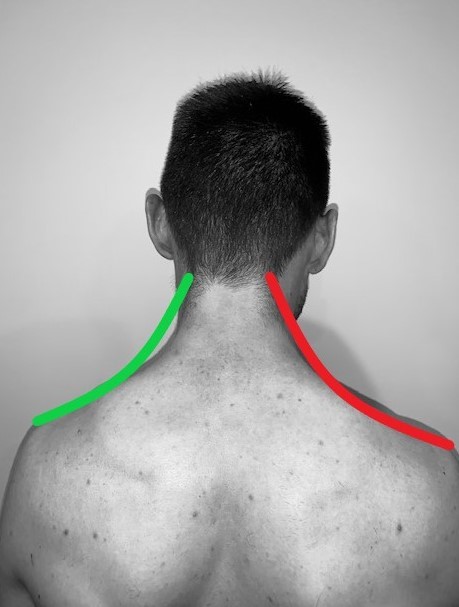 Shrugging off your Neck Pain | Physiohealth